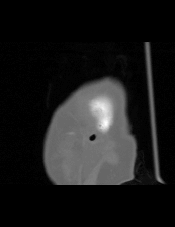 Case Review With Massive ICH, IVH, Brain Edema and Acute HC | The ...